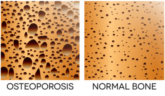 Bone Density - Mobile Quality Diagnostic